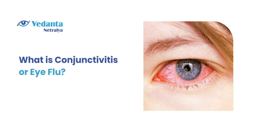 What is Conjunctivitis or Eye Flu? - Vedanta Netralya